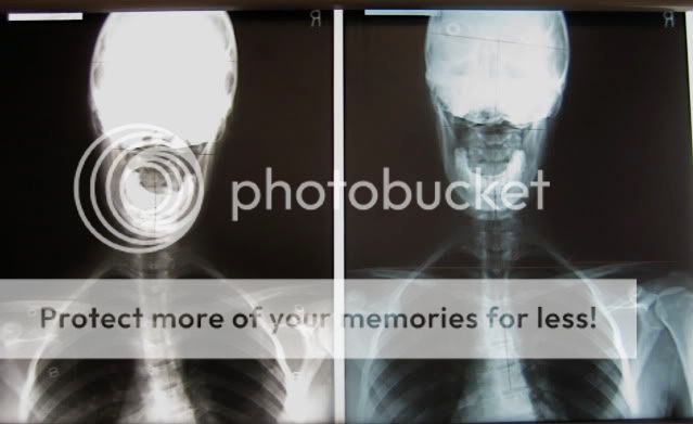 dextroscoliosis images | Getbackinline's Blog